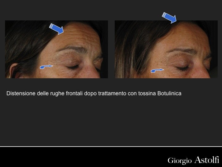 Botulino foto prima e dopo - dr. Giorgio Astolfi