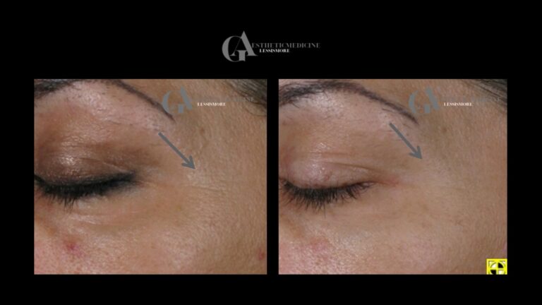 Botulino foto prima e dopo - dr. Giorgio Astolfi