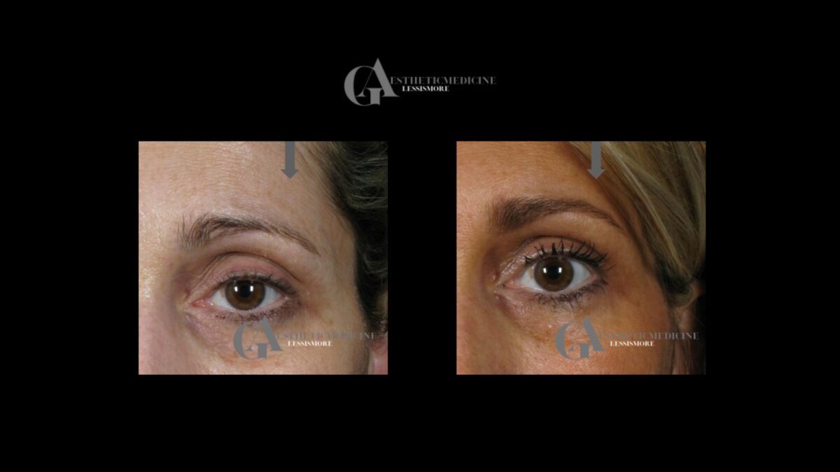 Botulino foto prima e dopo - dr. Giorgio Astolfi