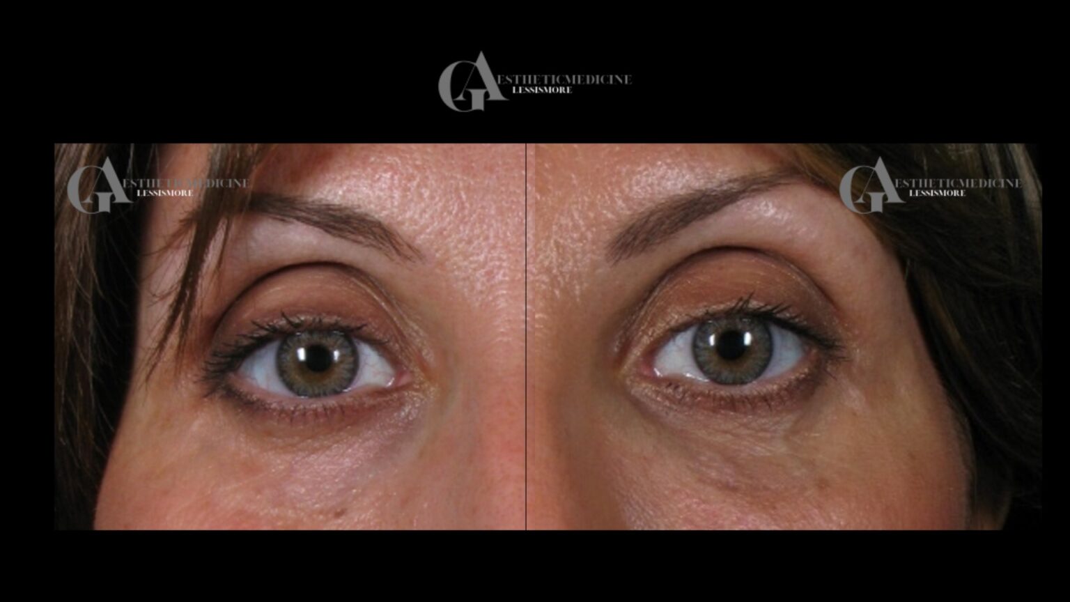 Botulino foto prima e dopo - dr. Giorgio Astolfi