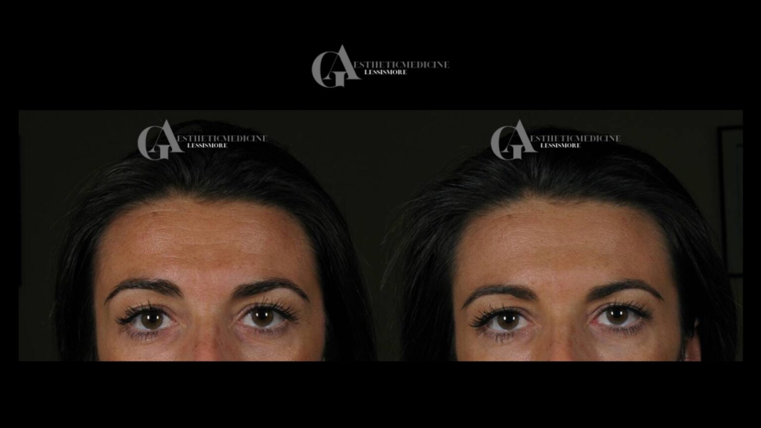 Botulino foto prima e dopo - dr. Giorgio Astolfi