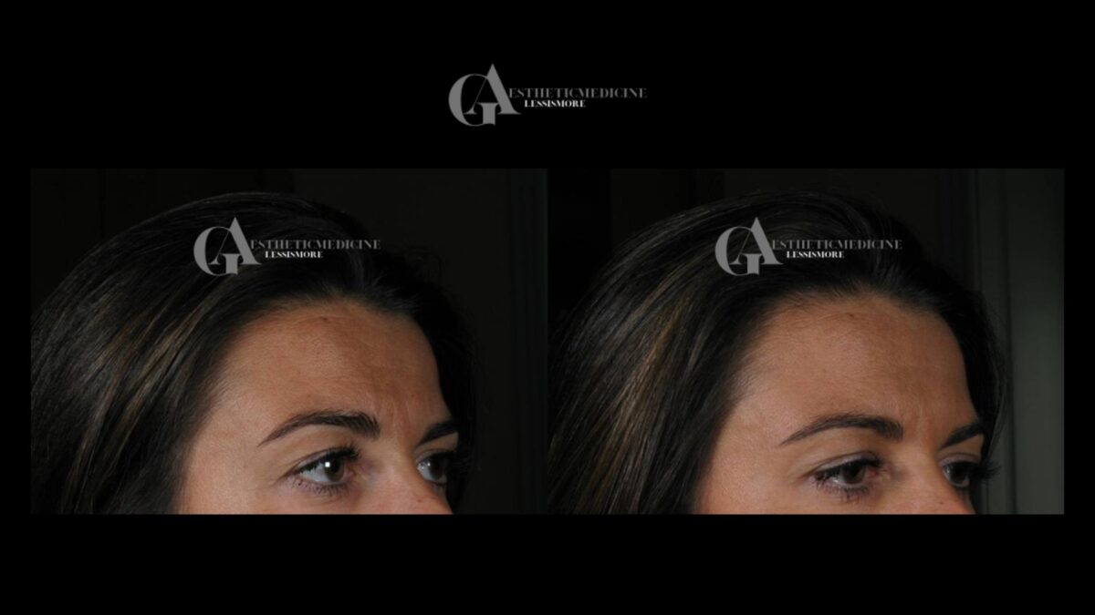 Botulino foto prima e dopo - dr. Giorgio Astolfi