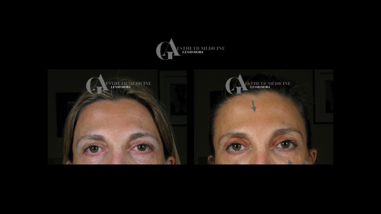 Botulino foto prima e dopo - dr. Giorgio Astolfi