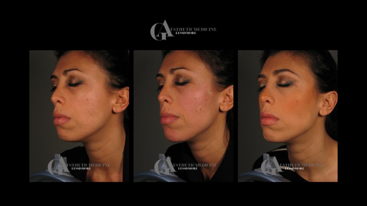 Botulino foto prima e dopo - dr. Giorgio Astolfi