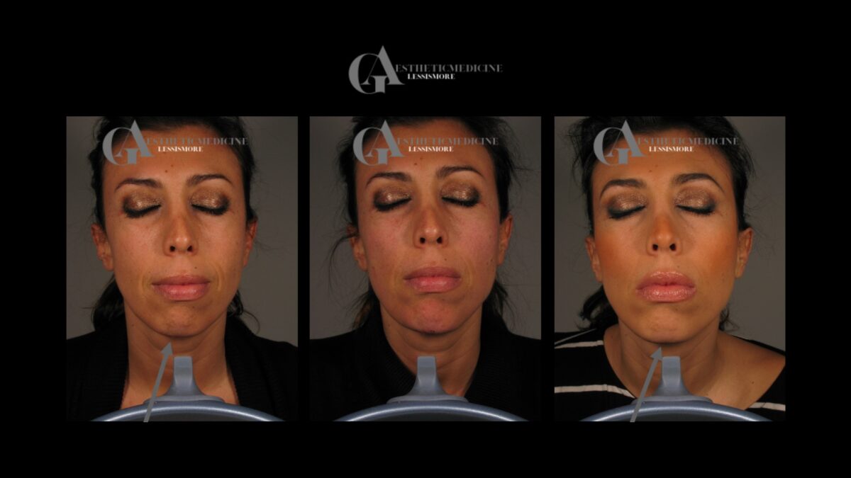 Botulino foto prima e dopo - dr. Giorgio Astolfi