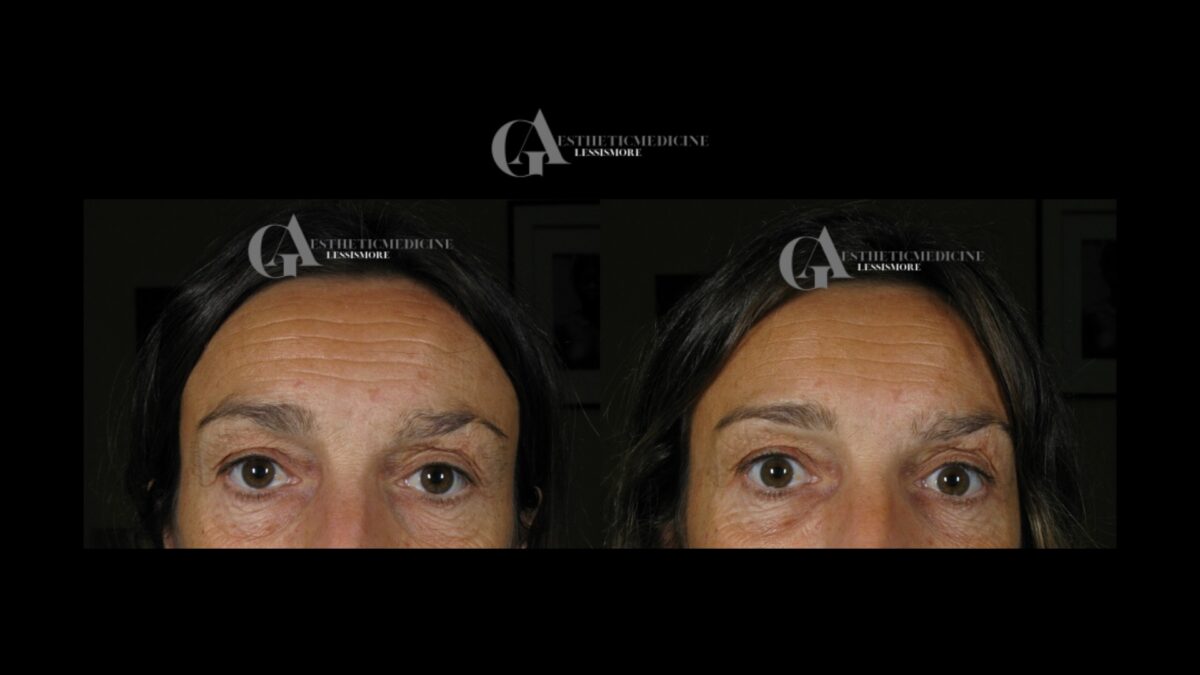 Botulino foto prima e dopo - dr. Giorgio Astolfi