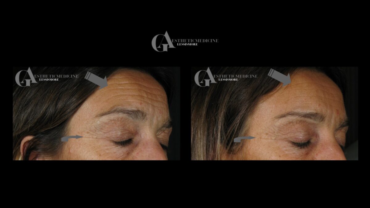 Botulino foto prima e dopo - dr. Giorgio Astolfi