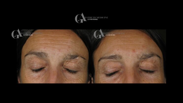 Botulino foto prima e dopo - dr. Giorgio Astolfi