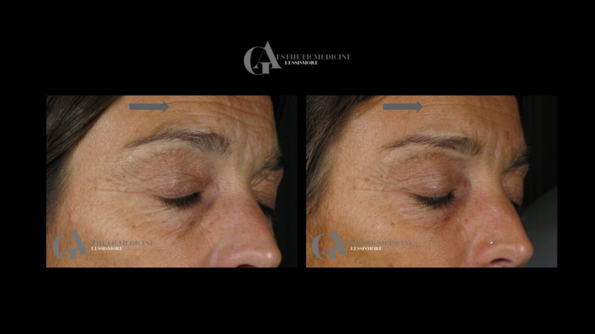 Botulino foto prima e dopo - dr. Giorgio Astolfi