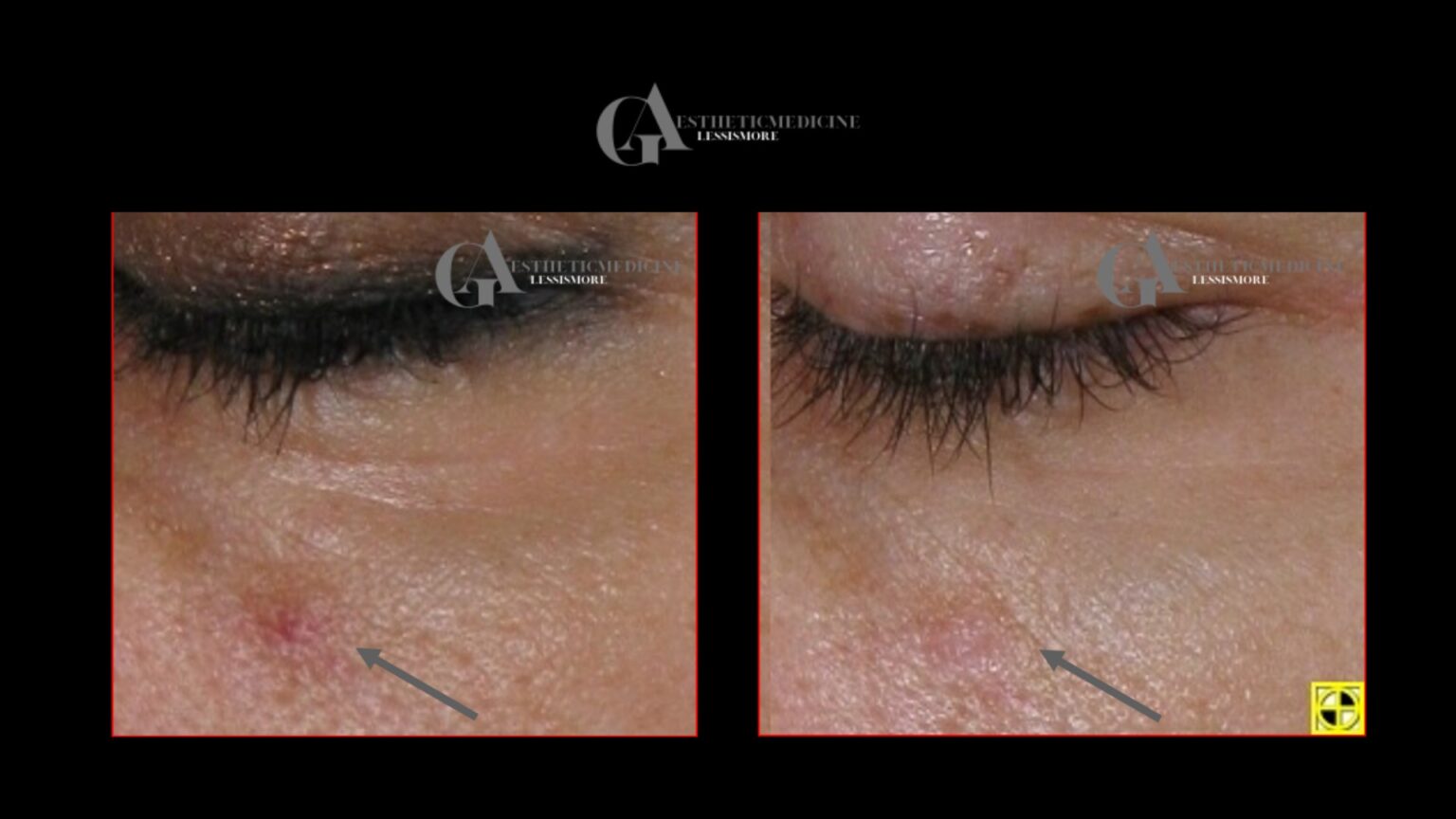 Botulino foto prima e dopo - dr. Giorgio Astolfi