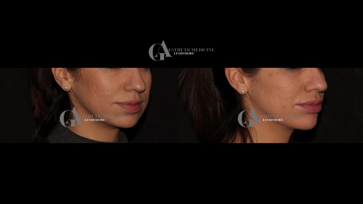 Full Face Treatment Foto Prima e Dopo - Dr. Giorgio Astolfi