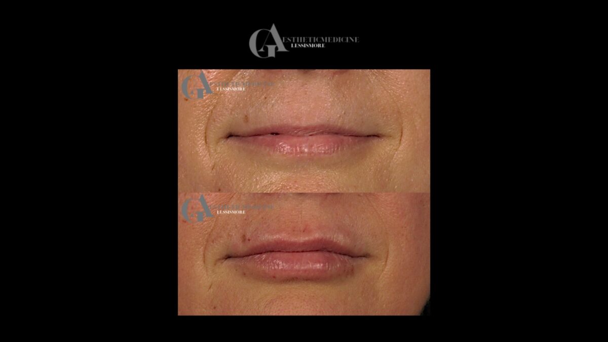 Filler per le Labbra - dott. Giorgio Astolfi