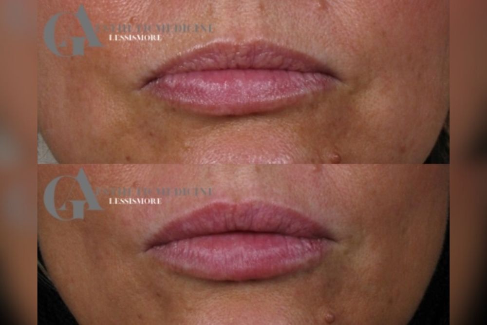 Hybrid Filler Facelift foto prima e dopo - Giorgio Astolfi